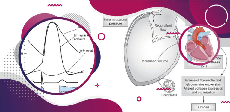 Insuficiência Aórtica - [thevalveclub]