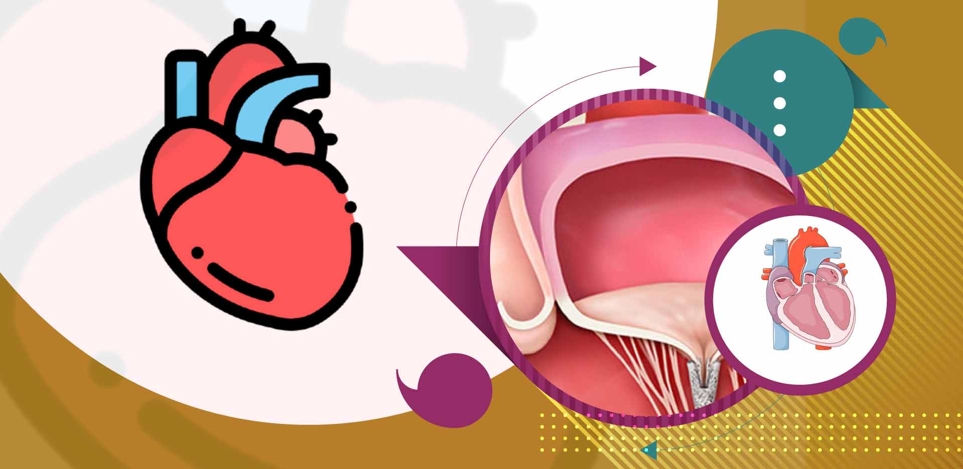 COAPT e MITRA-FR - The Valve Club