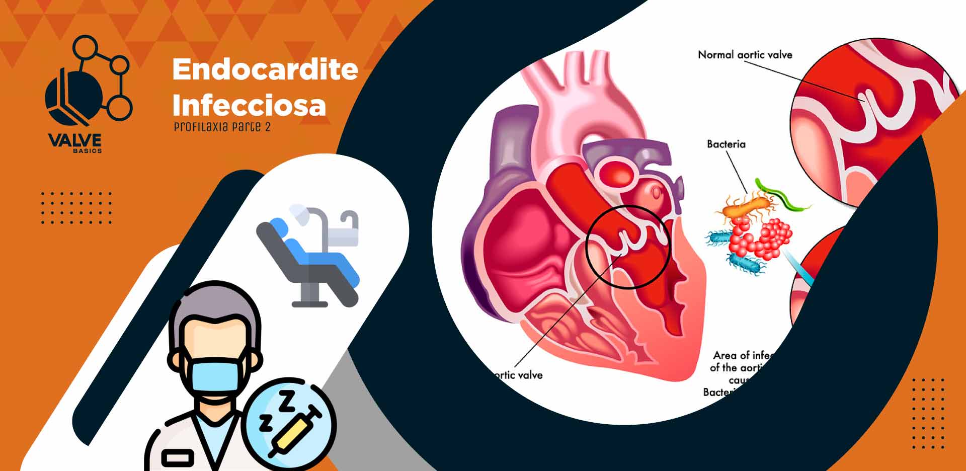 Endocardite Infecciosa - The Valve Club