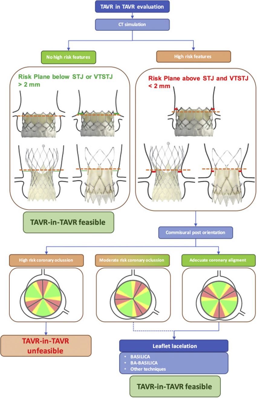 Oclusão coronariana na TAVI e TAVI-in-TAVI - [thevalveclub]